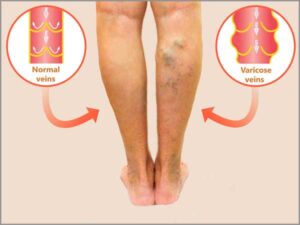 Varicose Veins Stripping - Greenview Medical Center